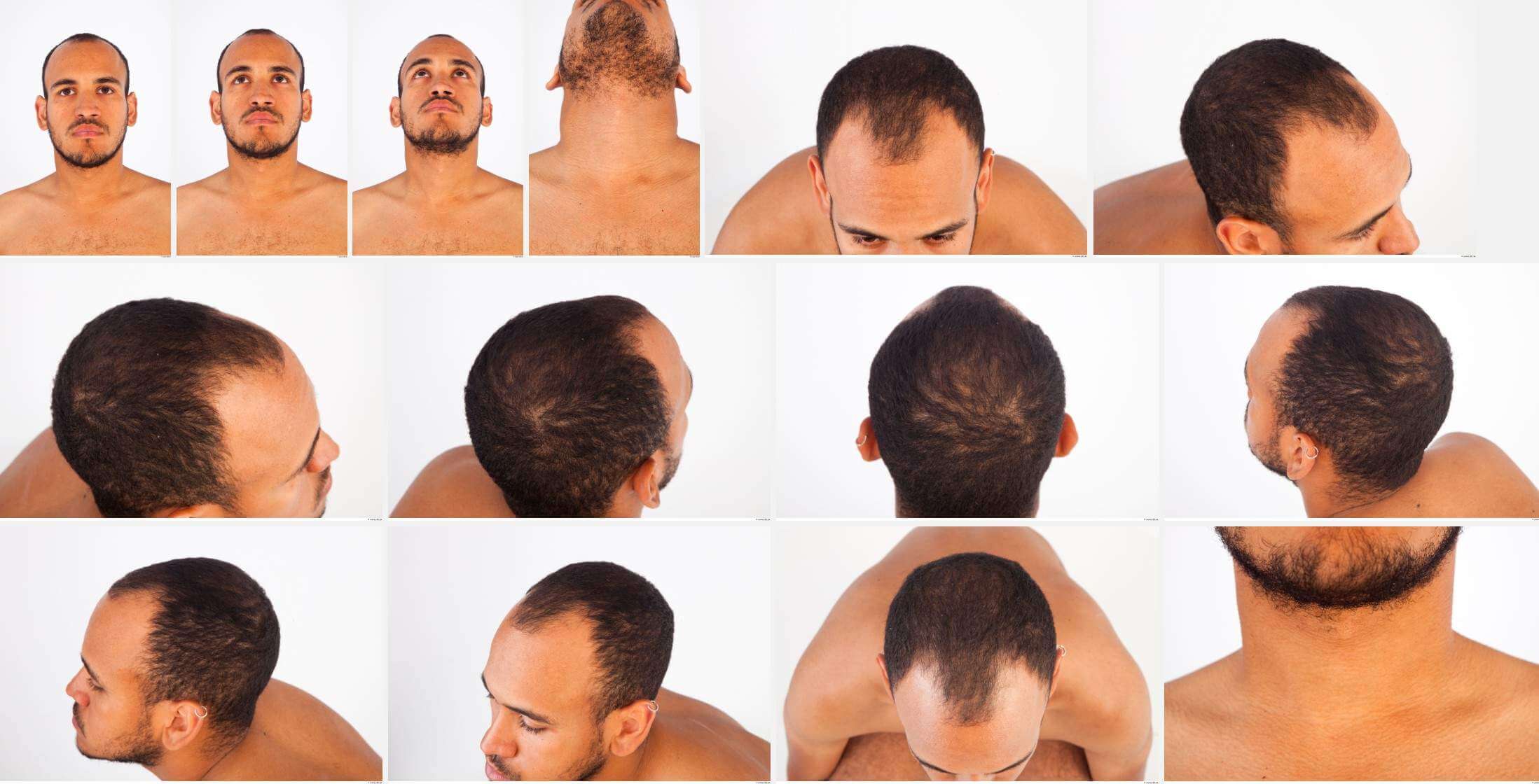 Glen High Res Skin Texture Photo Set by 3d-sk