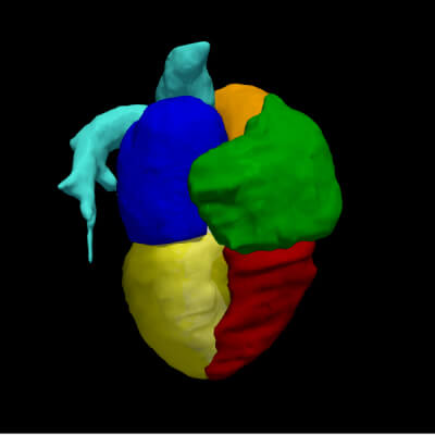 3D Heart Model - Generated From Real Patient by azekapeka