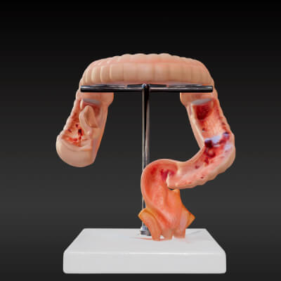 3D Model of Intestinal Diseases by azekapeka