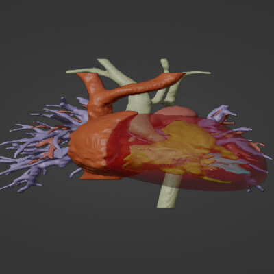 3D Model of Human Heart With Aortic Arch Hypoplasia - AAH by azekapeka