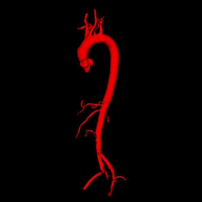 3D Model of Aorta and Aortic Vessel Tree by azekapeka