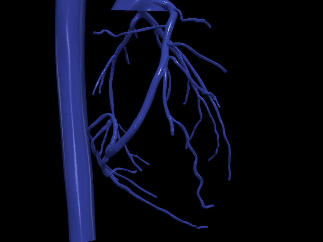 3D Model of Aorta and Coronary Arteries by azekapeka