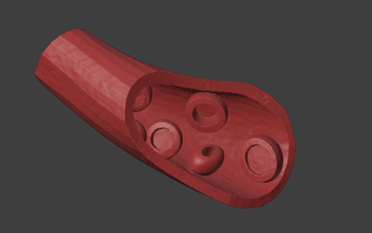3D Model of Artery With Atherosclerosis by azekapeka