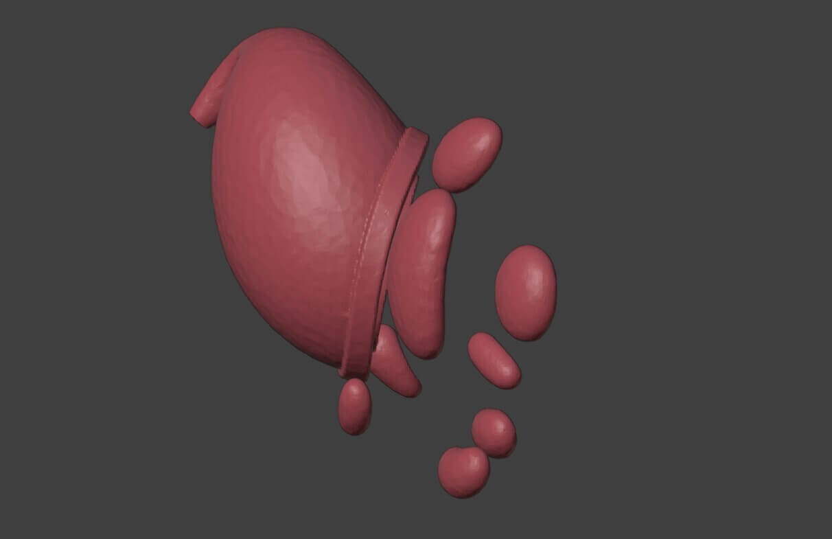 3D Model of Artery With Atherosclerosis by azekapeka