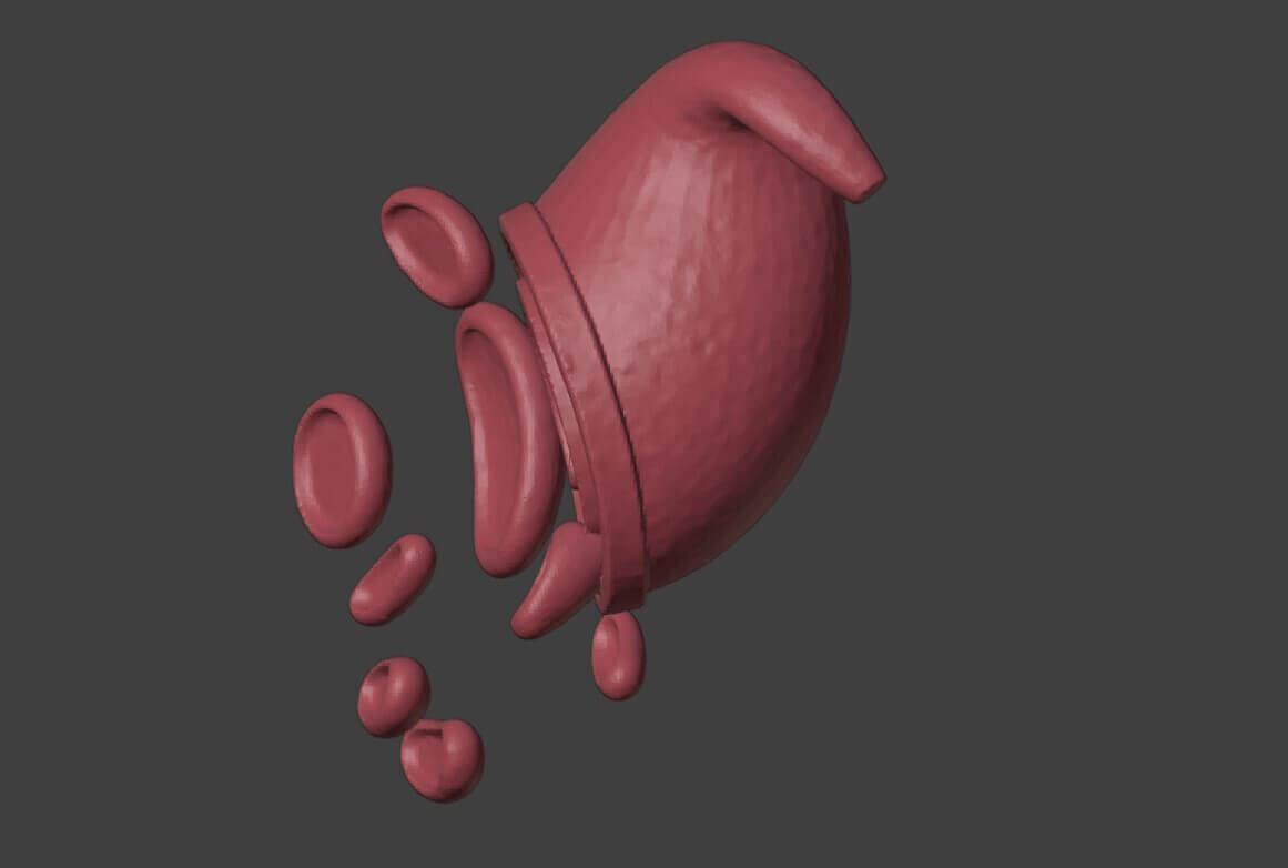 3D Model of Artery With Atherosclerosis by azekapeka