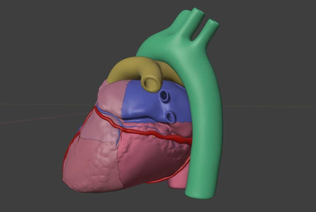 3D Model of Heart With Atrioventricular Septal Defect by azekapeka