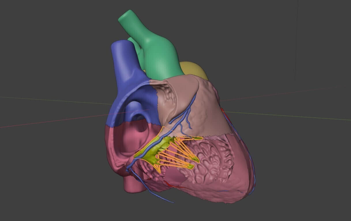 3D Model of Heart With Atrioventricular Septal Defect by azekapeka