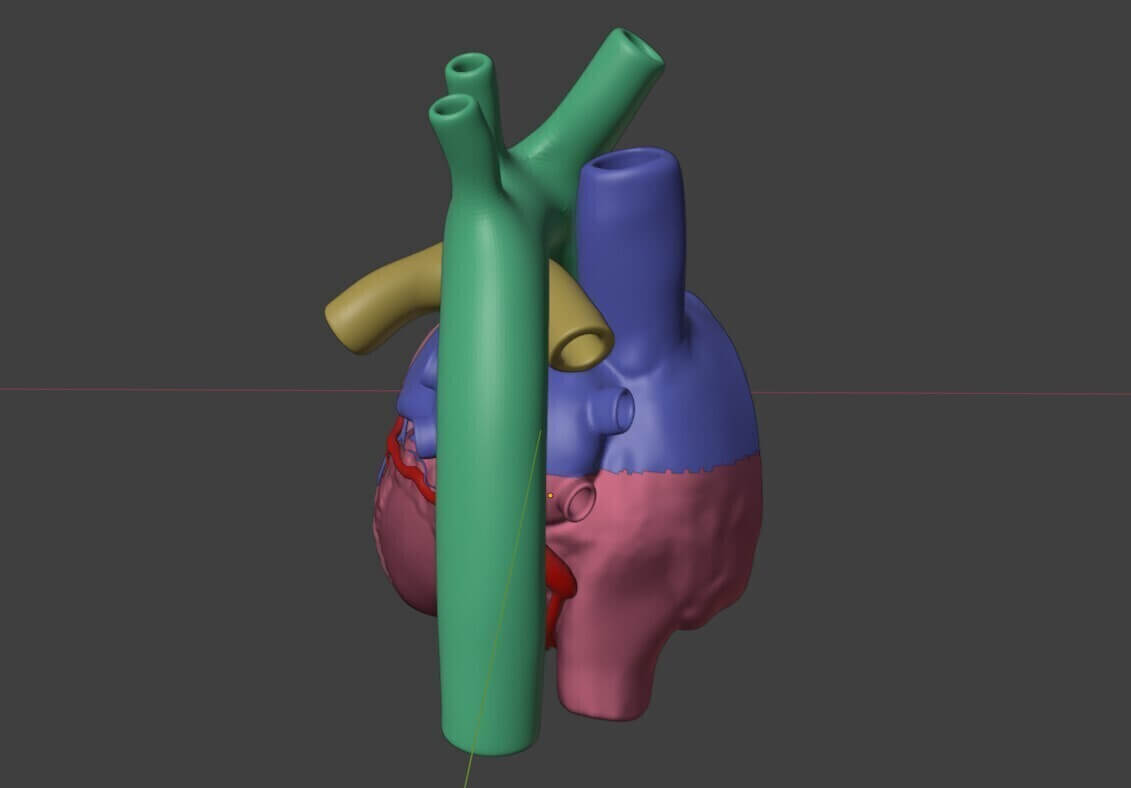 3D Model of Heart With Atrioventricular Septal Defect by azekapeka