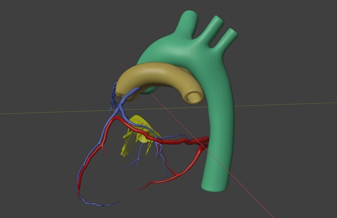 3D Model of Heart With Atrioventricular Septal Defect by azekapeka