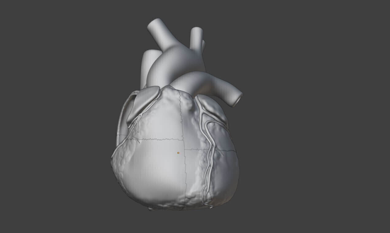 3D Model of Heart With Atrioventricular Septal Defect by azekapeka