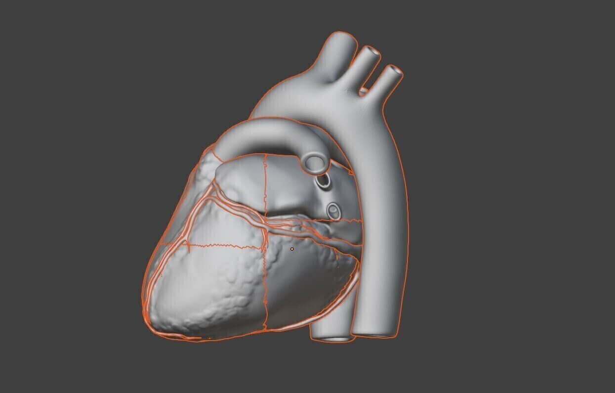 3D Model of Heart With Atrioventricular Septal Defect by azekapeka