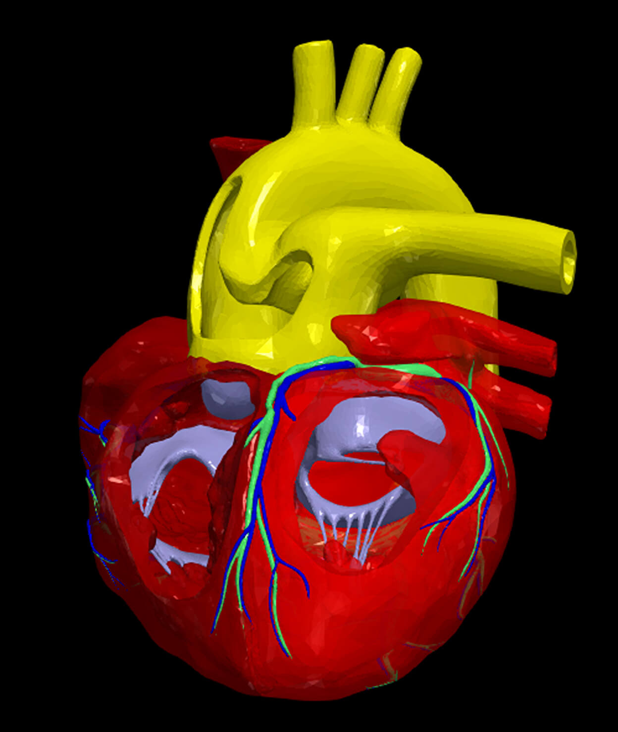 3D Model of Common Arterial Trunk Truncus Arteriosus by azekapeka