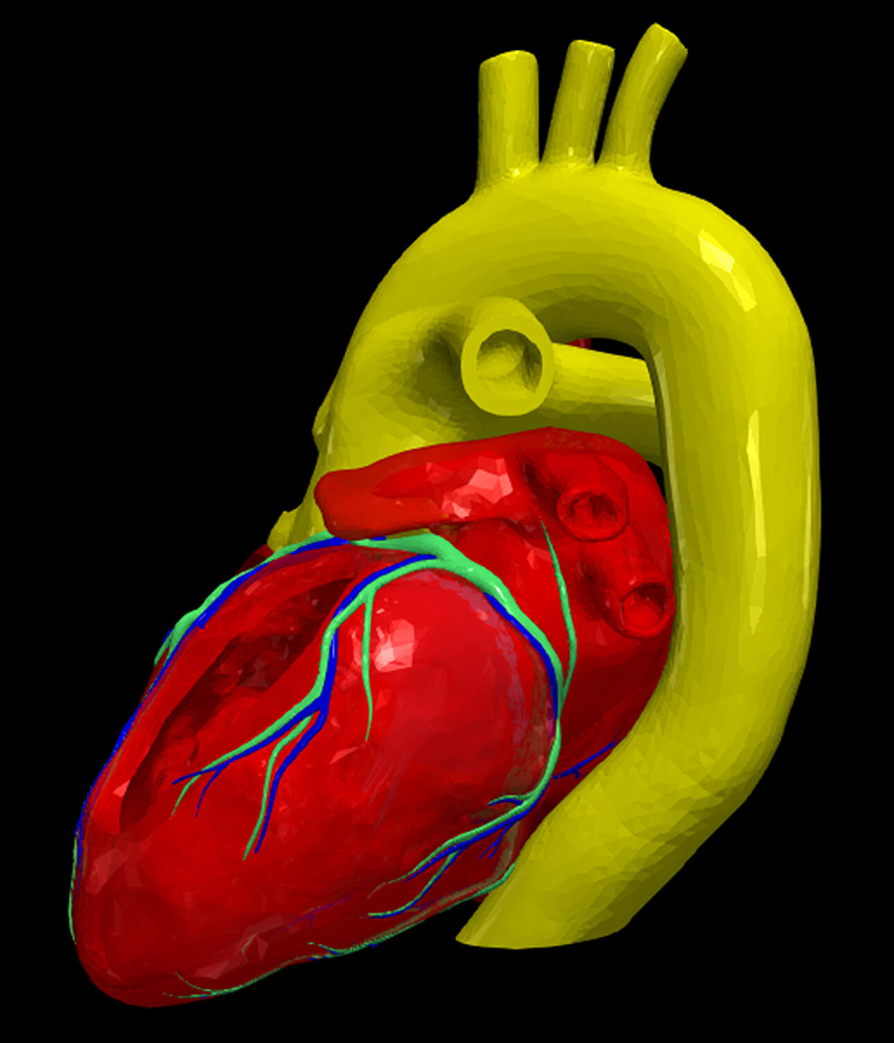3D Model of Common Arterial Trunk Truncus Arteriosus by azekapeka