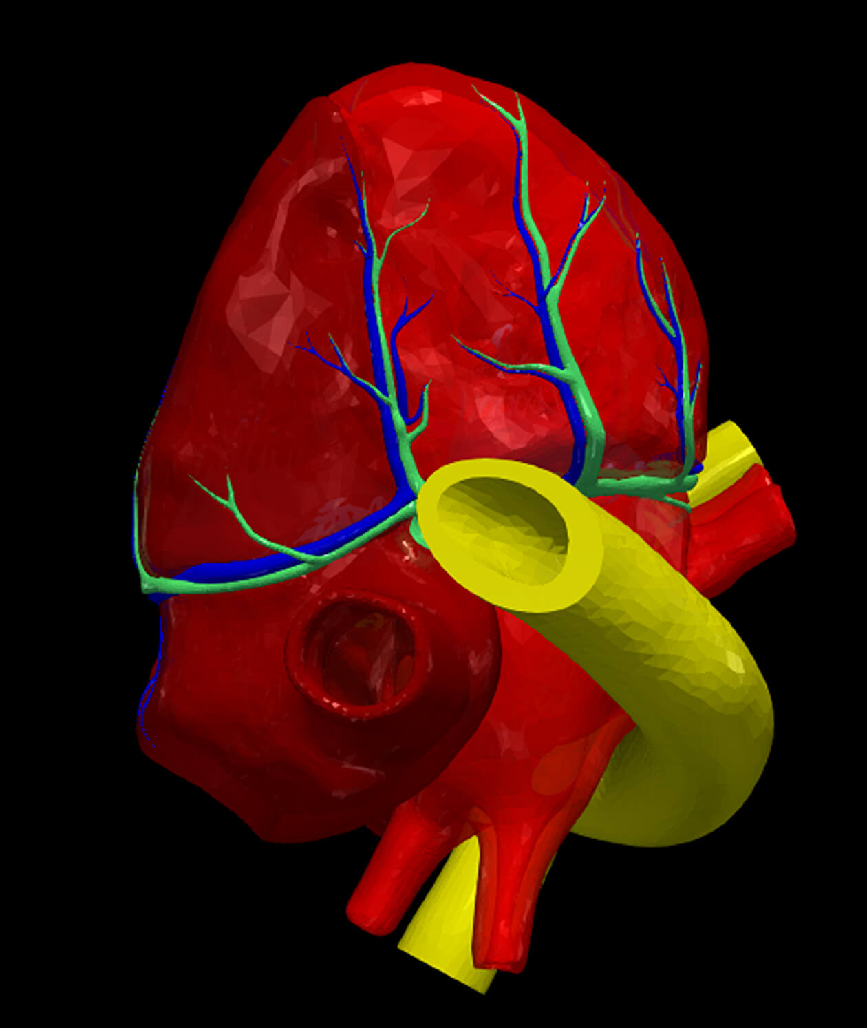 3D Model of Common Arterial Trunk Truncus Arteriosus by azekapeka