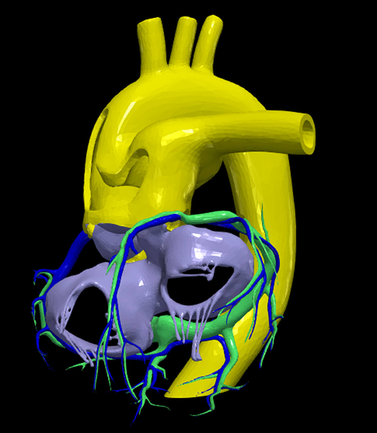 3D Model of Common Arterial Trunk Truncus Arteriosus by azekapeka
