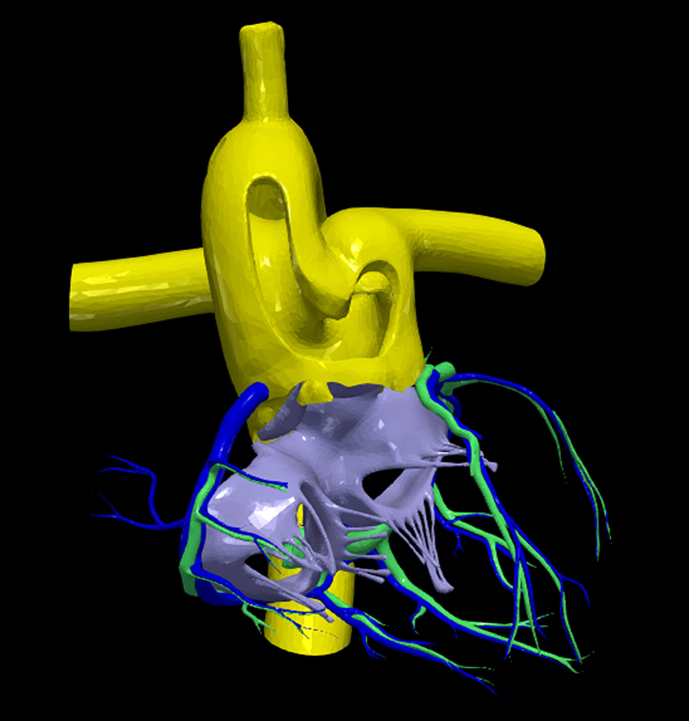 3D Model of Common Arterial Trunk Truncus Arteriosus by azekapeka