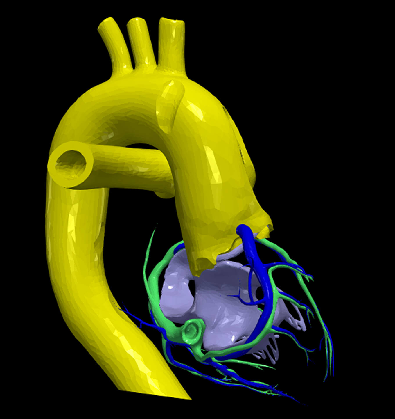 3D Model of Common Arterial Trunk Truncus Arteriosus by azekapeka