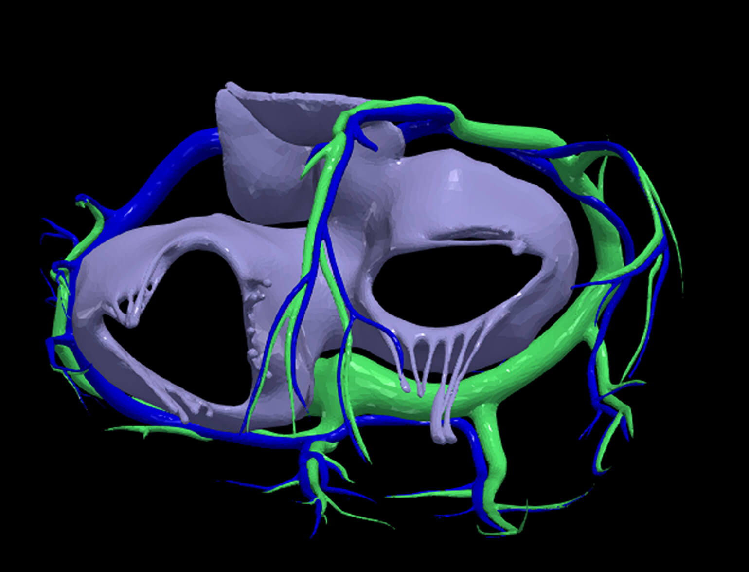 3D Model of Common Arterial Trunk Truncus Arteriosus by azekapeka