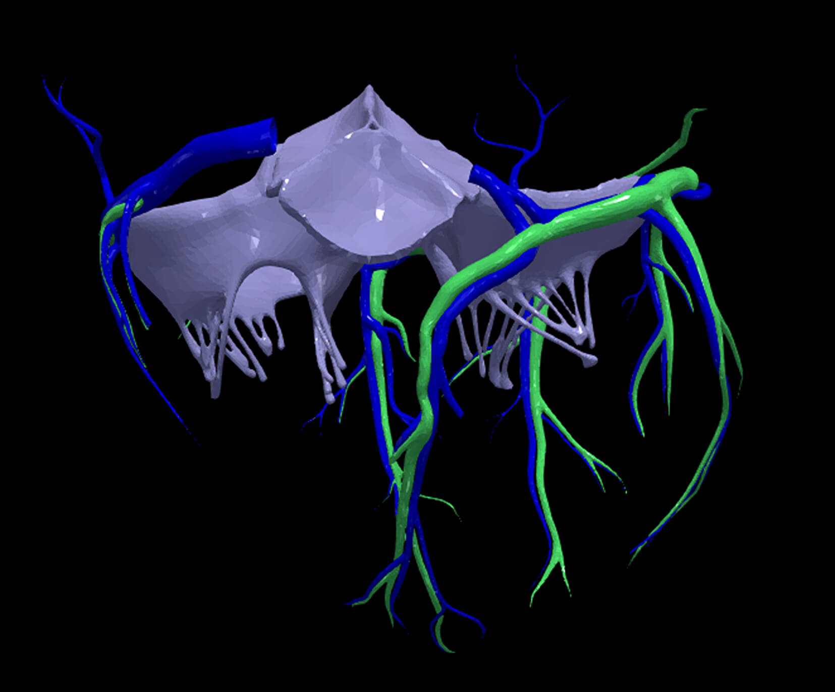 3D Model of Common Arterial Trunk Truncus Arteriosus by azekapeka