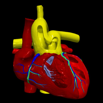 3D Model of Common Arterial Trunk Truncus Arteriosus by azekapeka