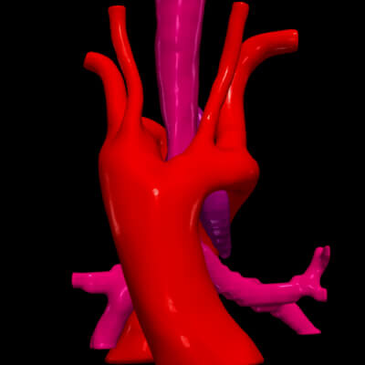 3D Model of Double Aortic Arch by azekapeka