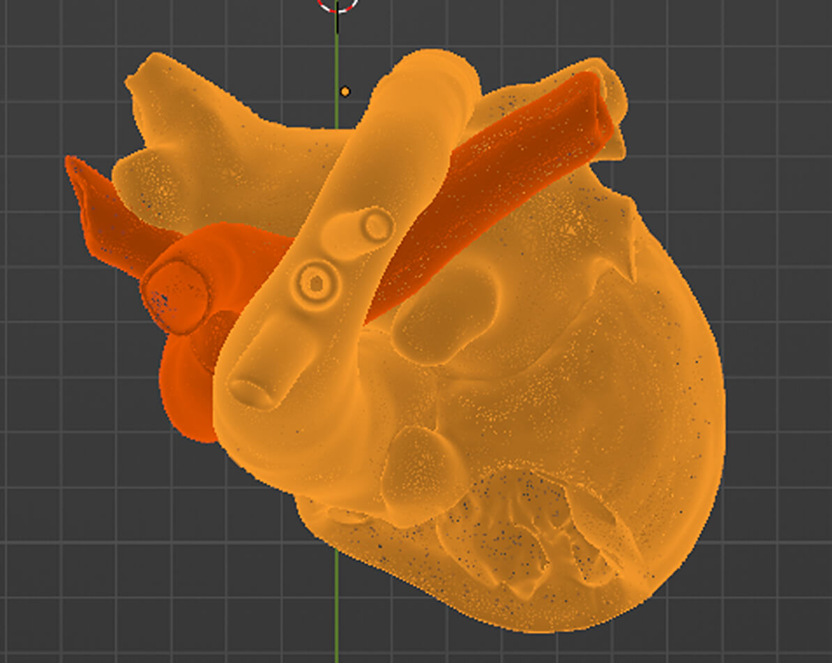 3D Model of Heart After Fontan Procedure by azekapeka