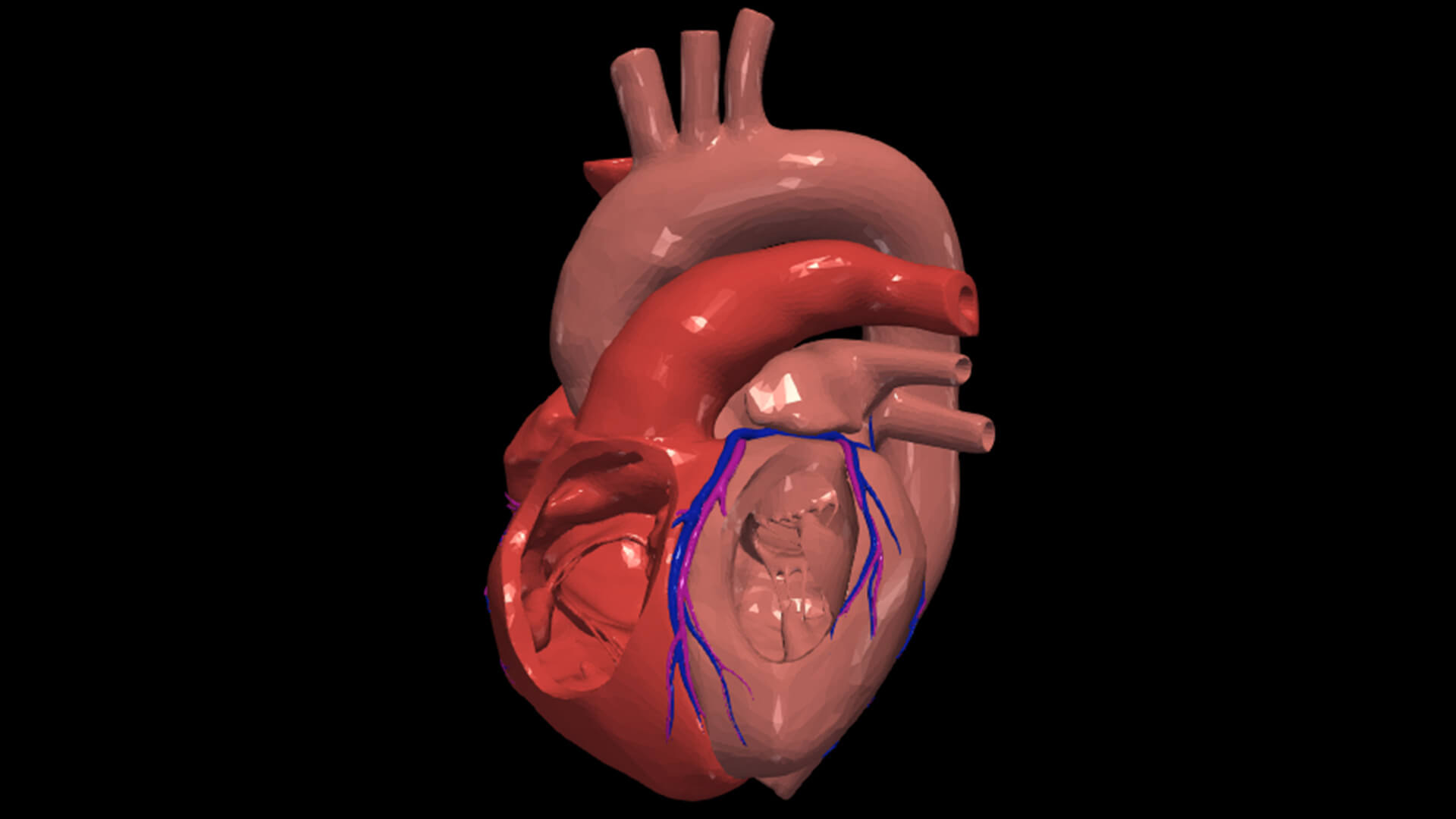 3D Model of Heart With Atrial Septal Defect by azekapeka
