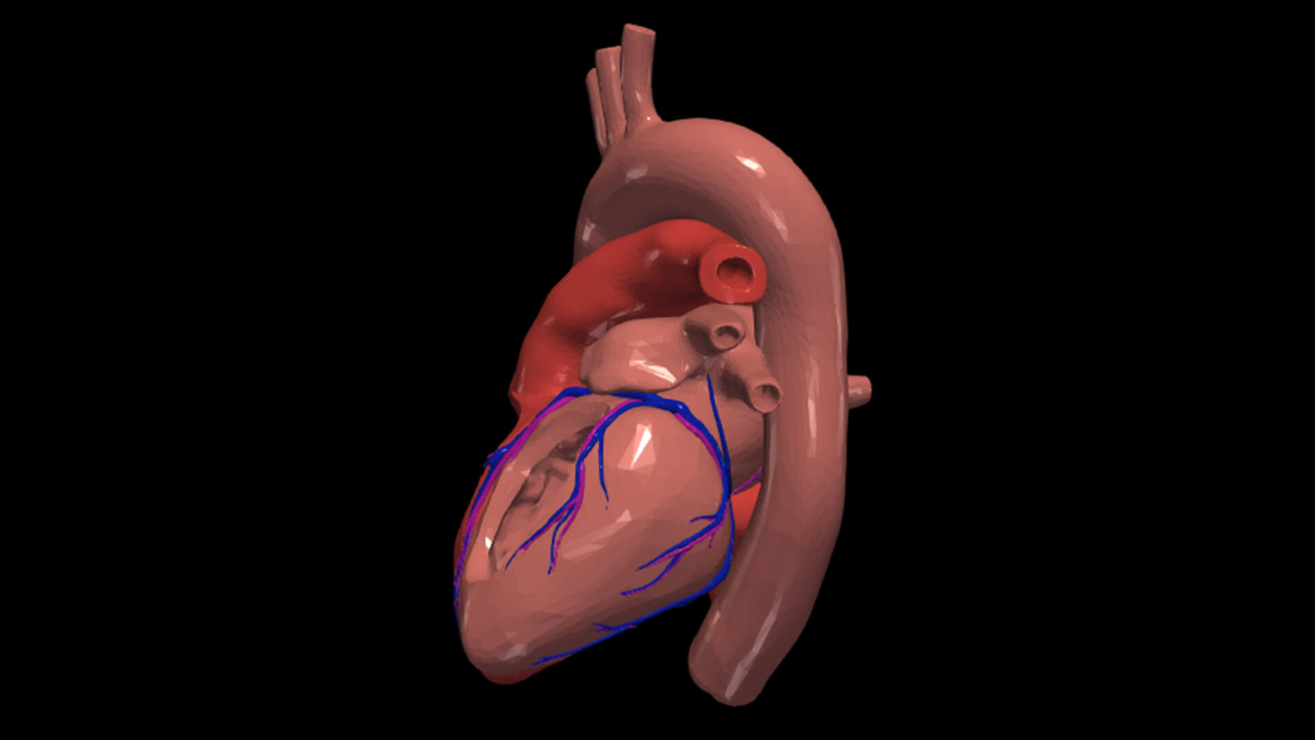 3D Model of Heart With Atrial Septal Defect by azekapeka