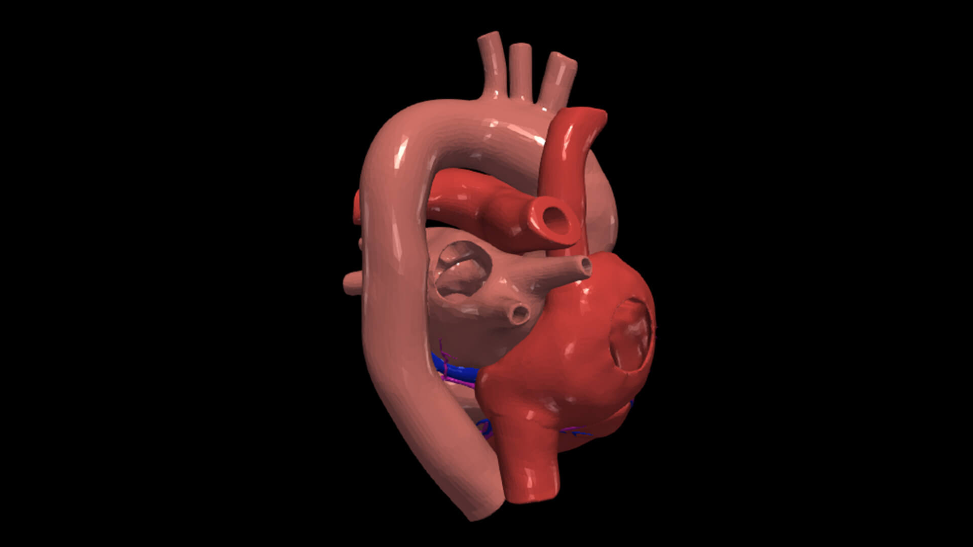 3D Model of Heart With Atrial Septal Defect by azekapeka