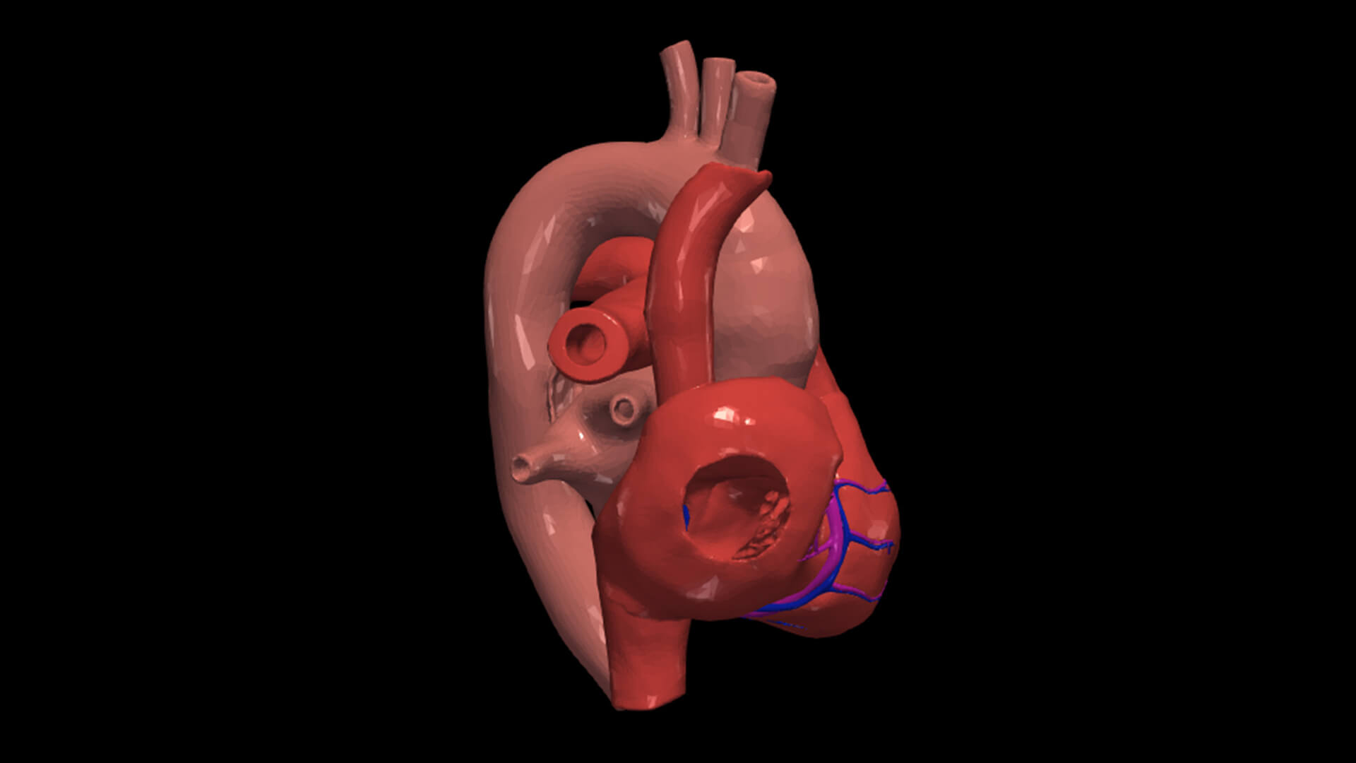 3D Model of Heart With Atrial Septal Defect by azekapeka