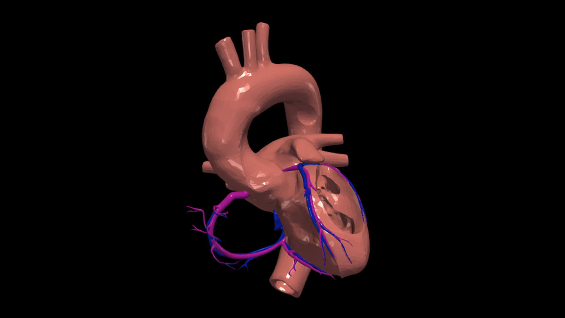 3D Model of Heart With Atrial Septal Defect by azekapeka