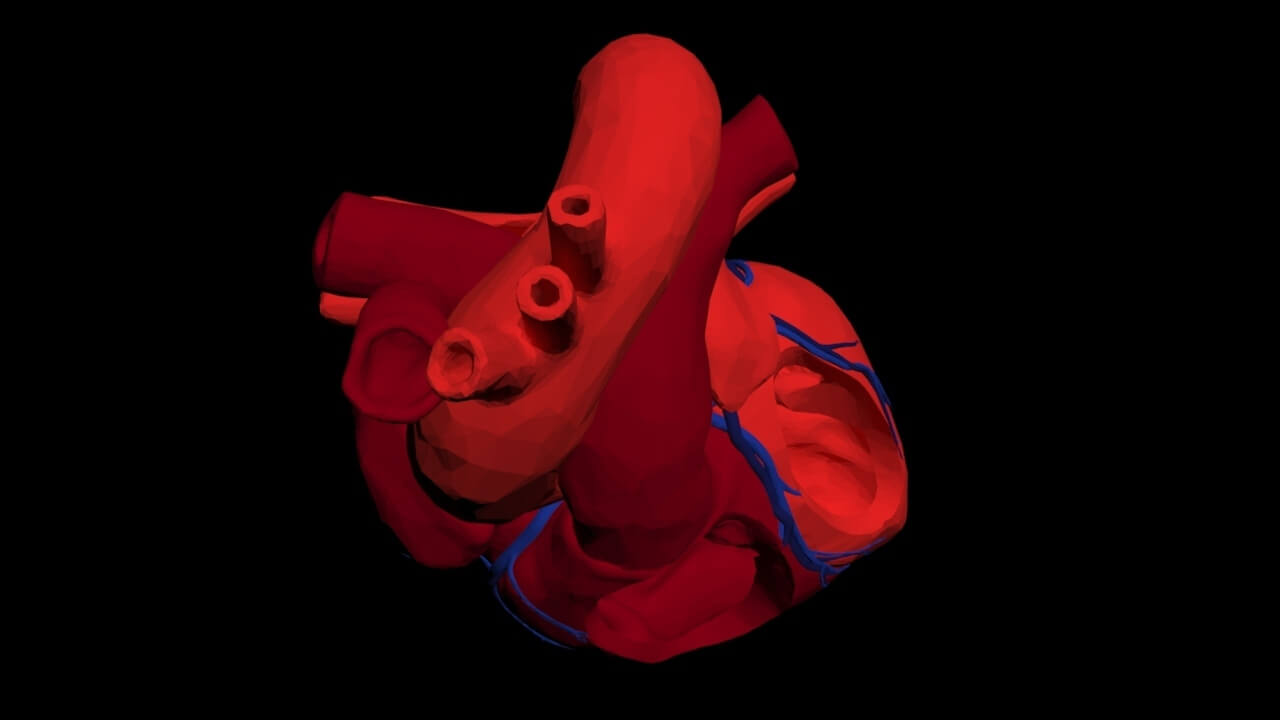 3D Model of Heart With Atrial Septal Defect by azekapeka
