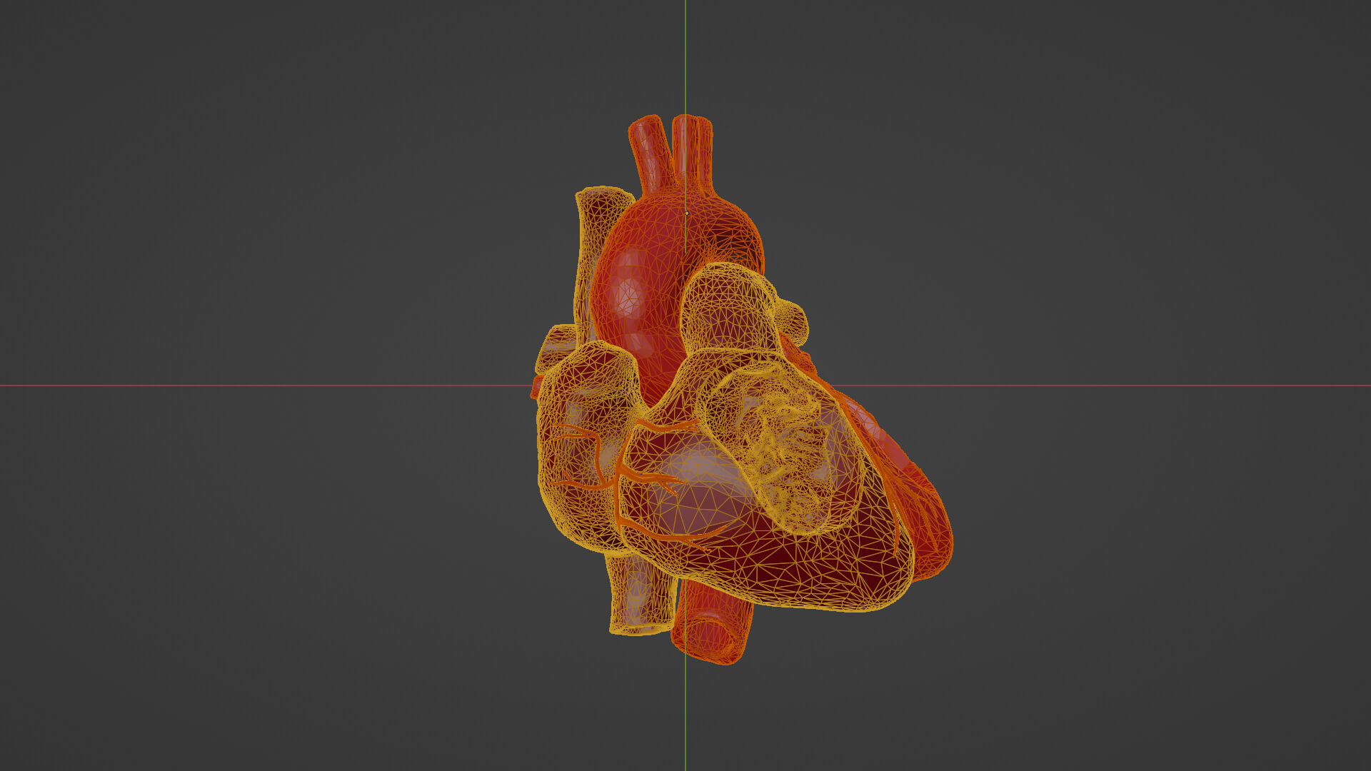 3D Model of Heart With Atrial Septal Defect by azekapeka