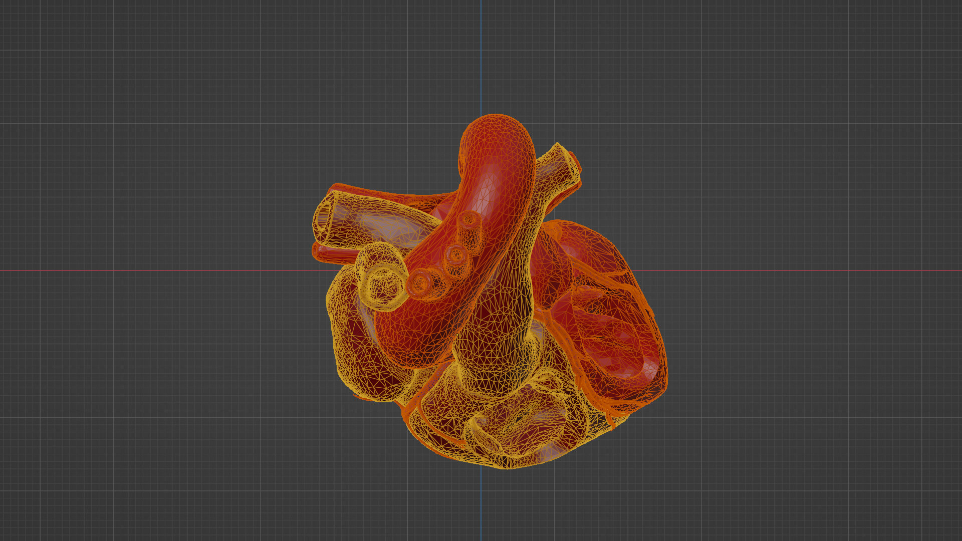 3D Model of Heart With Atrial Septal Defect by azekapeka