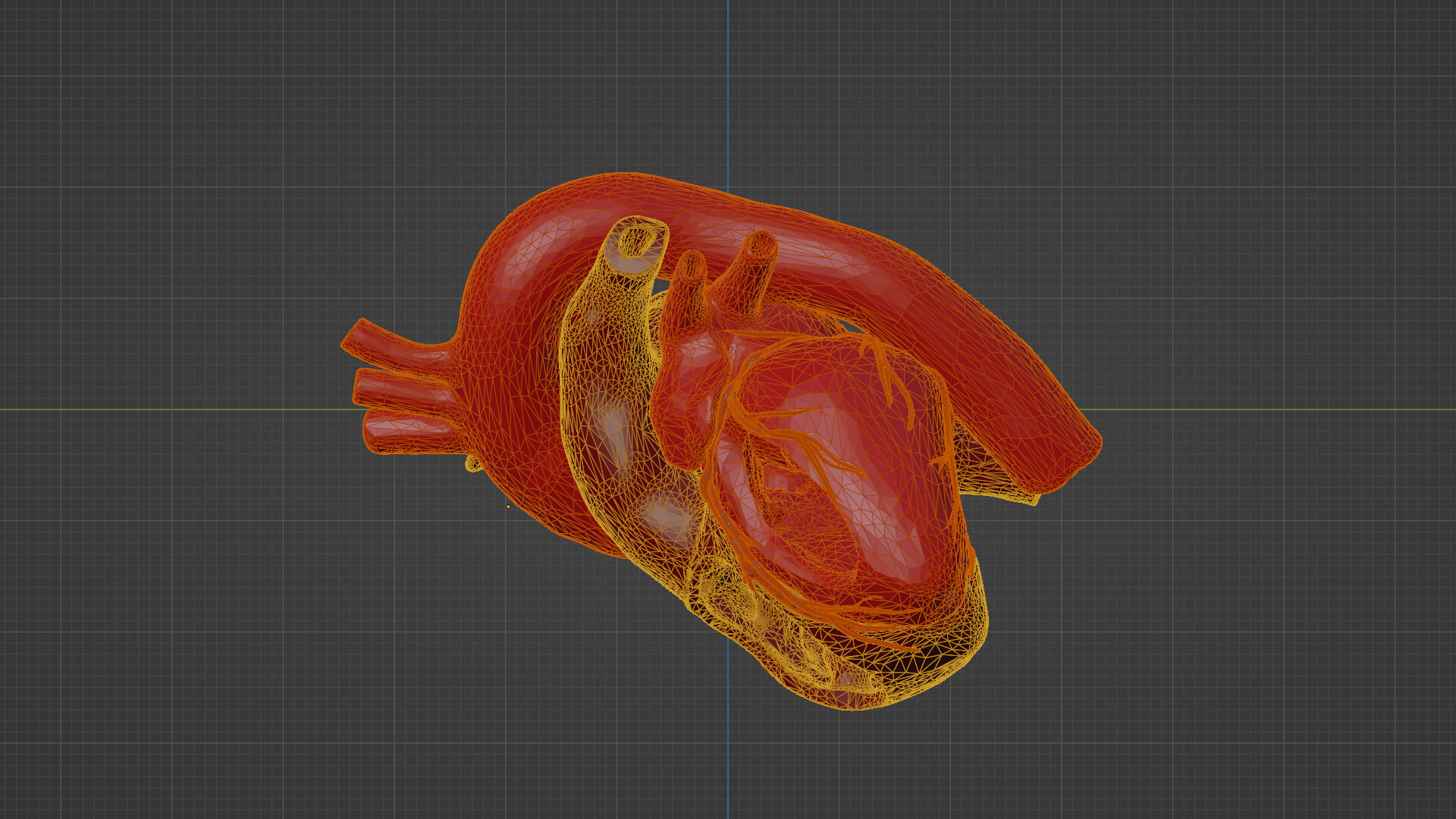 3D Model of Heart With Atrial Septal Defect by azekapeka