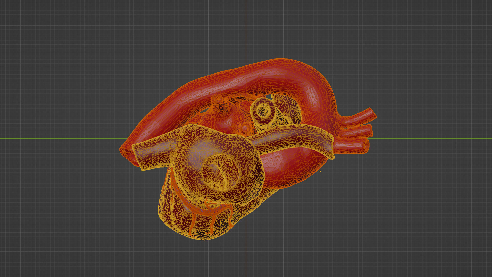 3D Model of Heart With Atrial Septal Defect by azekapeka