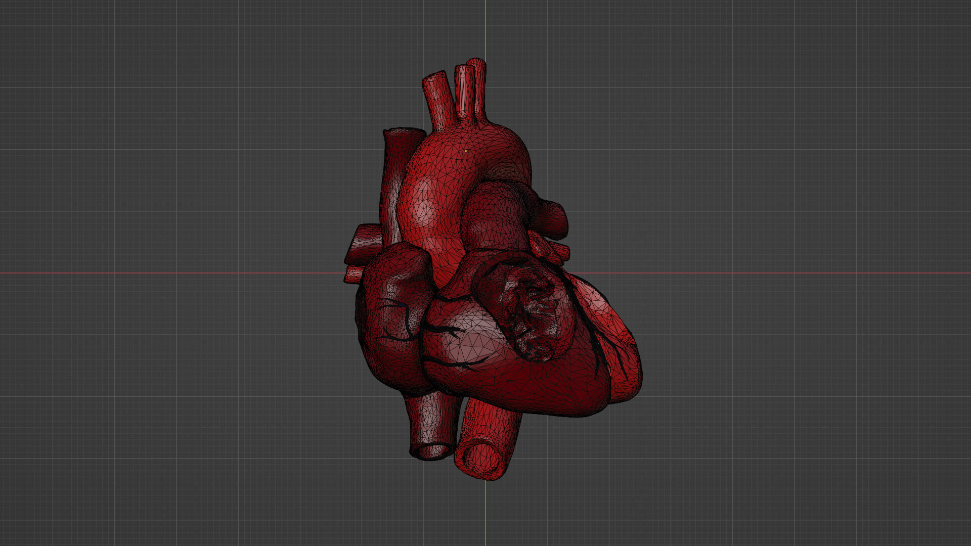 3D Model of Heart With Atrial Septal Defect by azekapeka