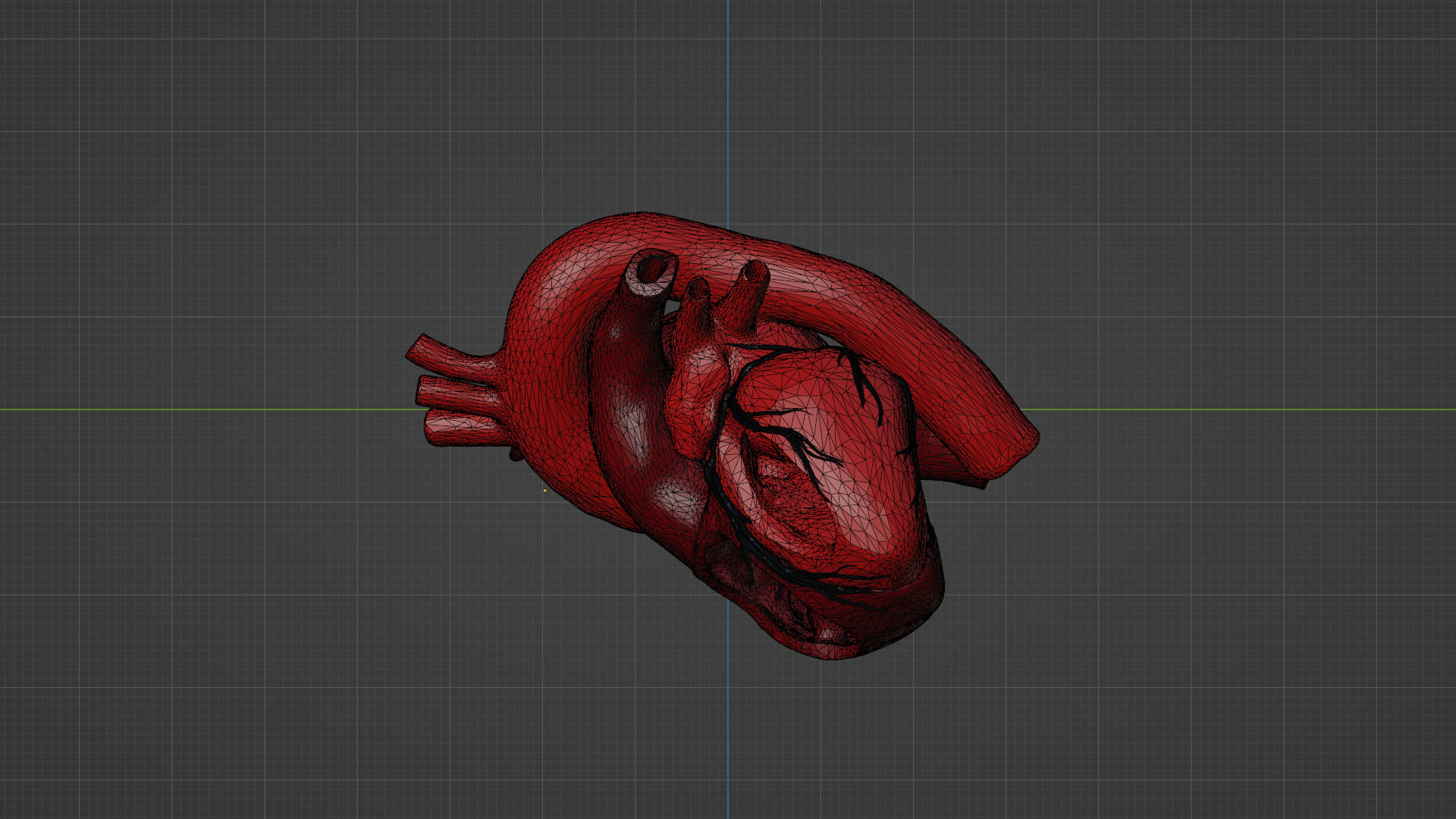 3D Model of Heart With Atrial Septal Defect by azekapeka
