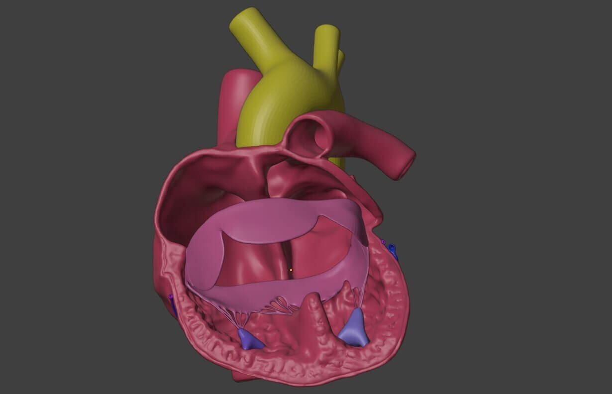 3D Model of Heart With Atrioventricular Canal Defect by azekapeka