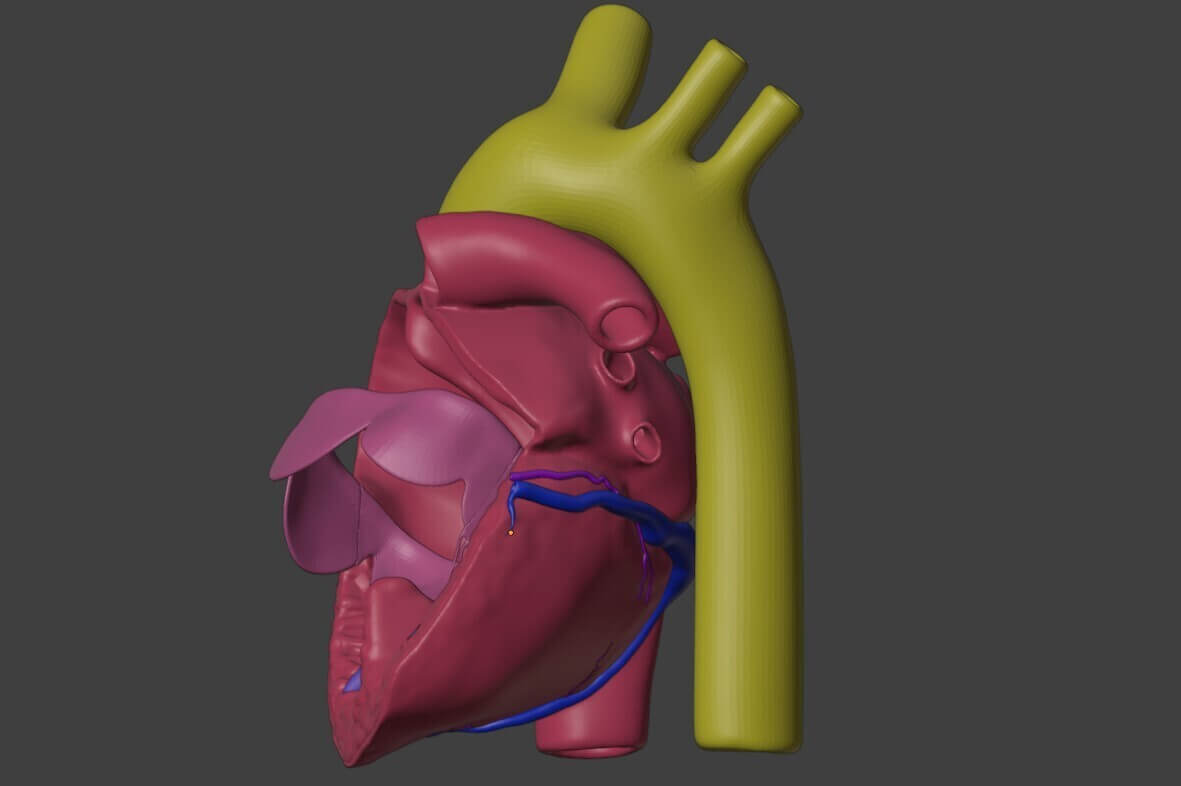 3D Model of Heart With Atrioventricular Canal Defect by azekapeka