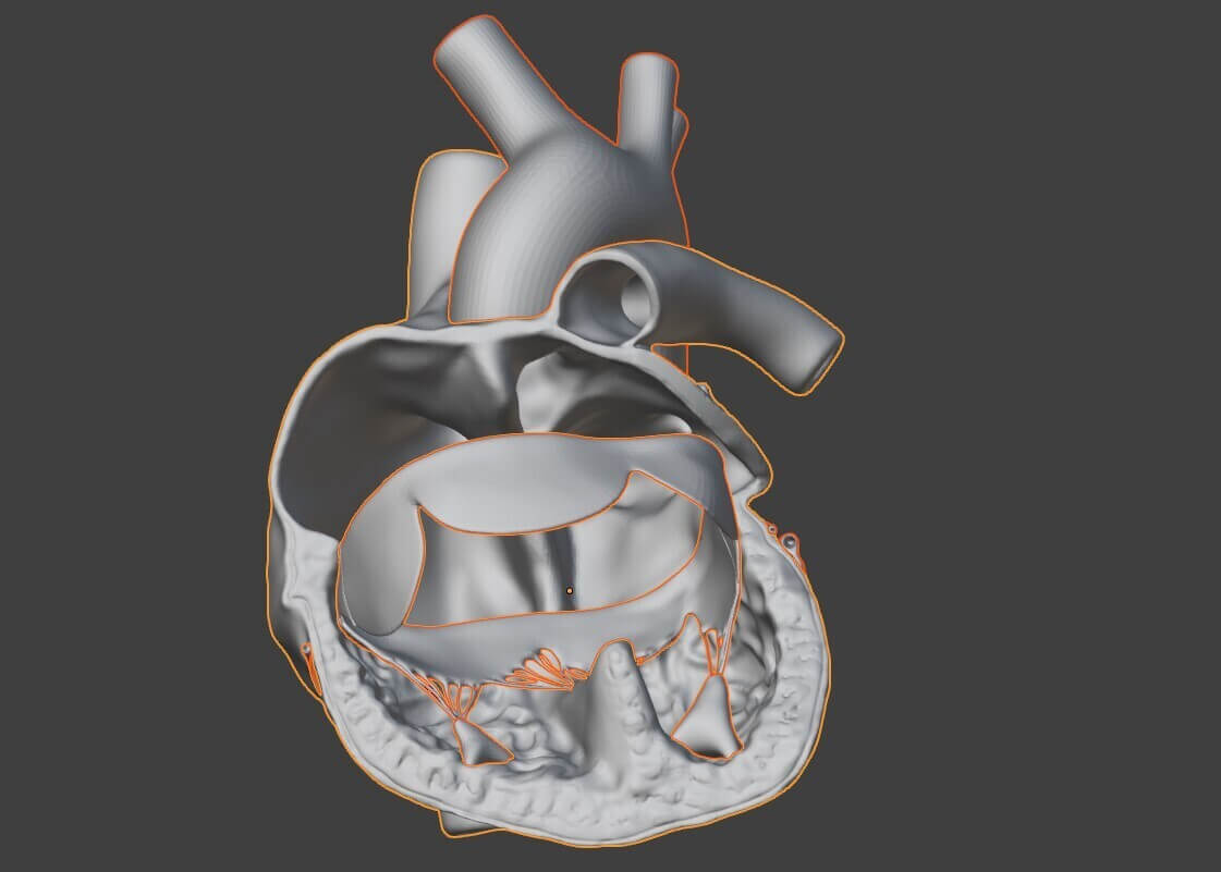 3D Model of Heart With Atrioventricular Canal Defect by azekapeka