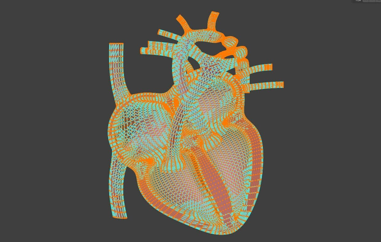3D Model of Heart With Coarctation of Aorta by azekapeka