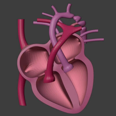 3D Model of Heart With Coarctation of Aorta by azekapeka