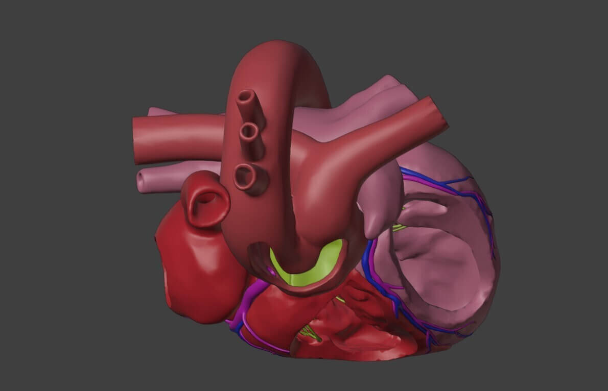 3D Model of Heart With Common Arterial Trunk Truncus by azekapeka