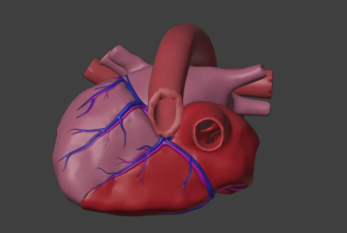 3D Model of Heart With Common Arterial Trunk Truncus by azekapeka