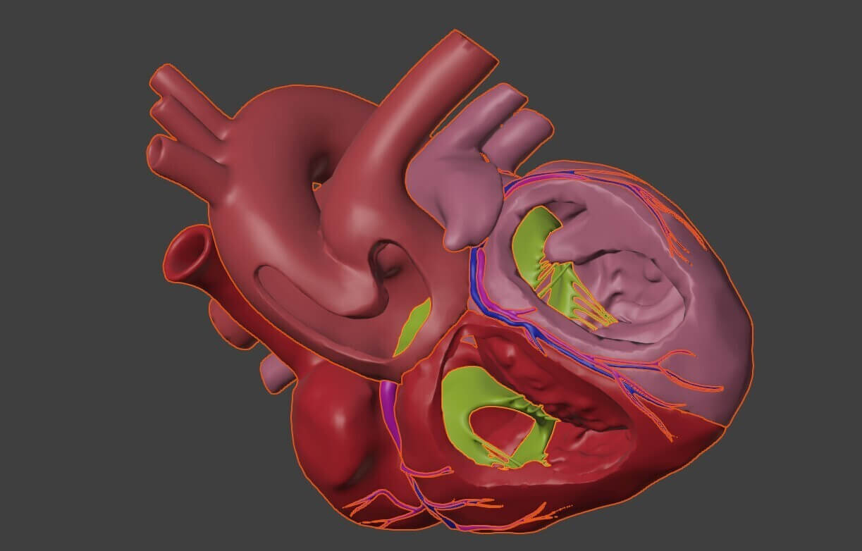 3D Model of Heart With Common Arterial Trunk Truncus by azekapeka