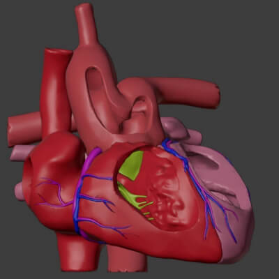 3D Model of Heart With Common Arterial Trunk Truncus by azekapeka