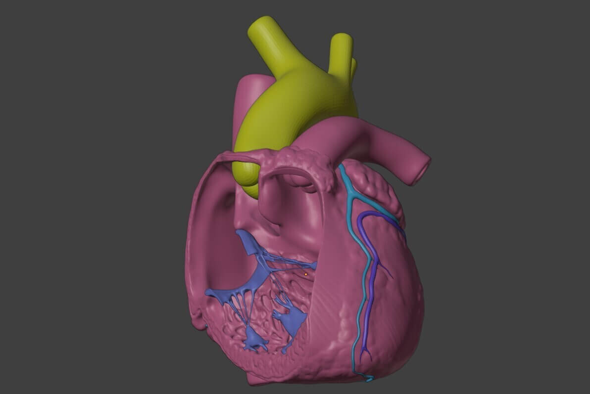 3D Model of Heart With Double Outlet Right Ventricle by azekapeka