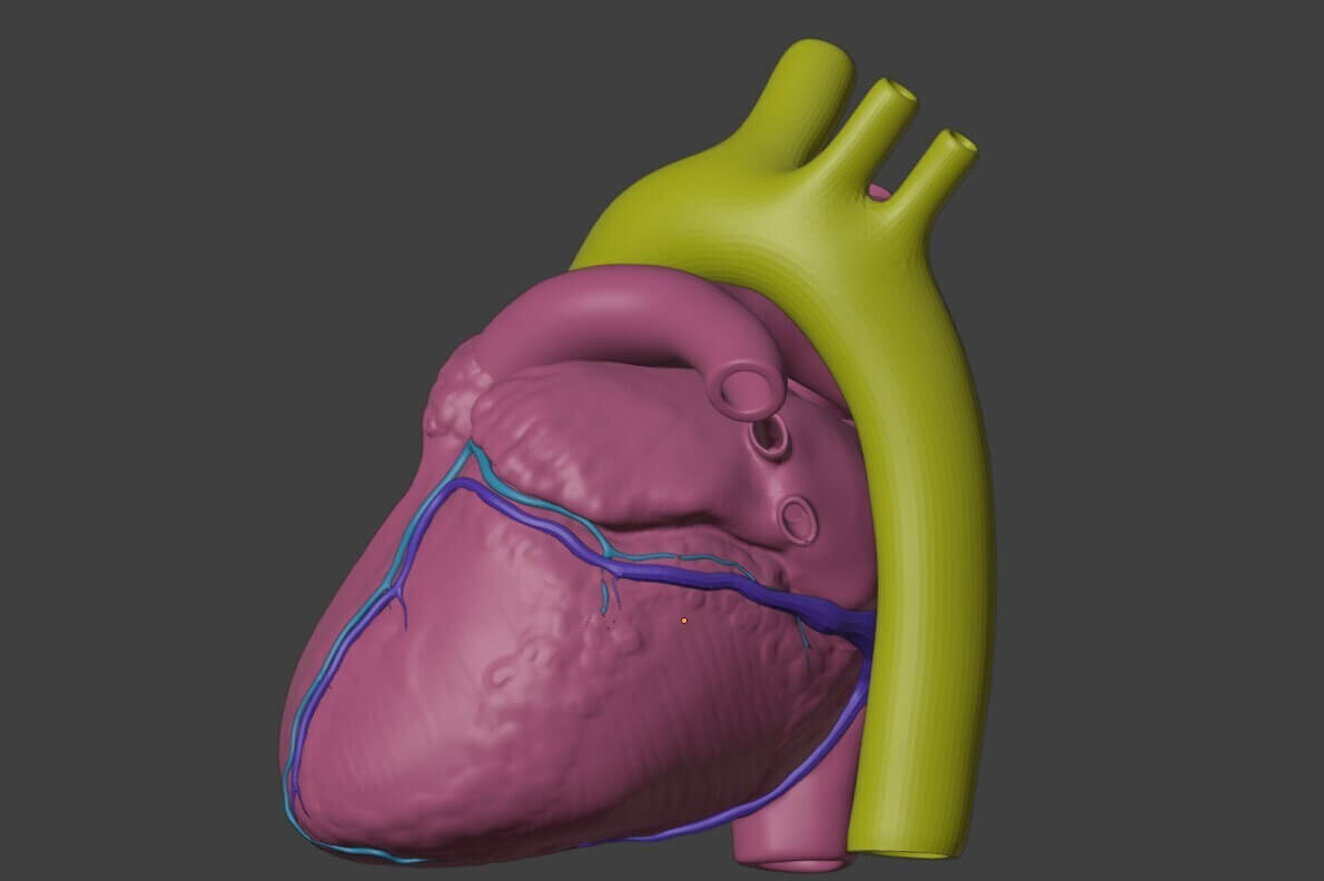 3D Model of Heart With Double Outlet Right Ventricle by azekapeka
