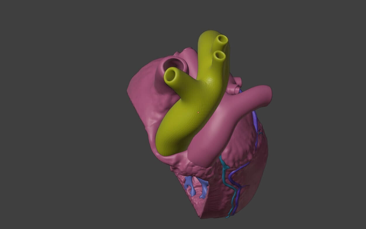 3D Model of Heart With Double Outlet Right Ventricle by azekapeka